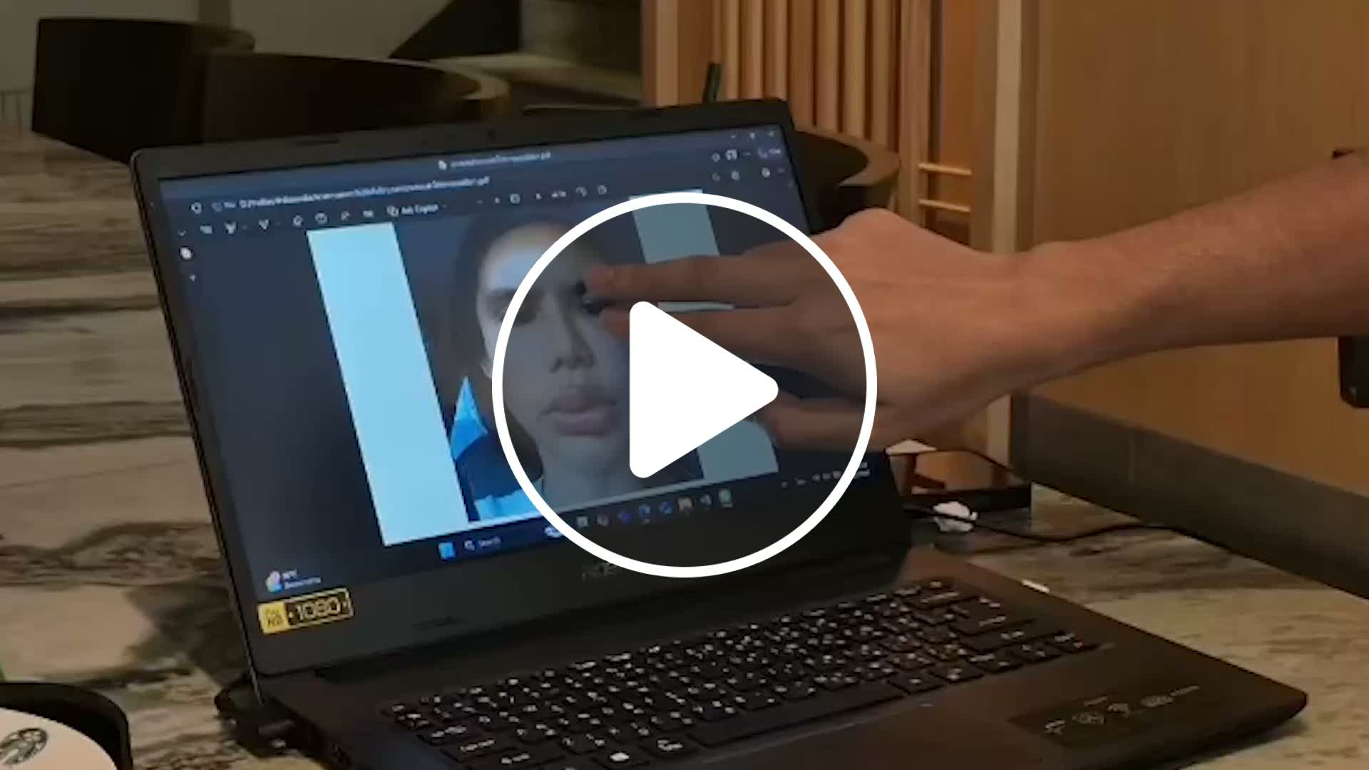 Woman whose facial fillers went wrong has had swollen features for two ...