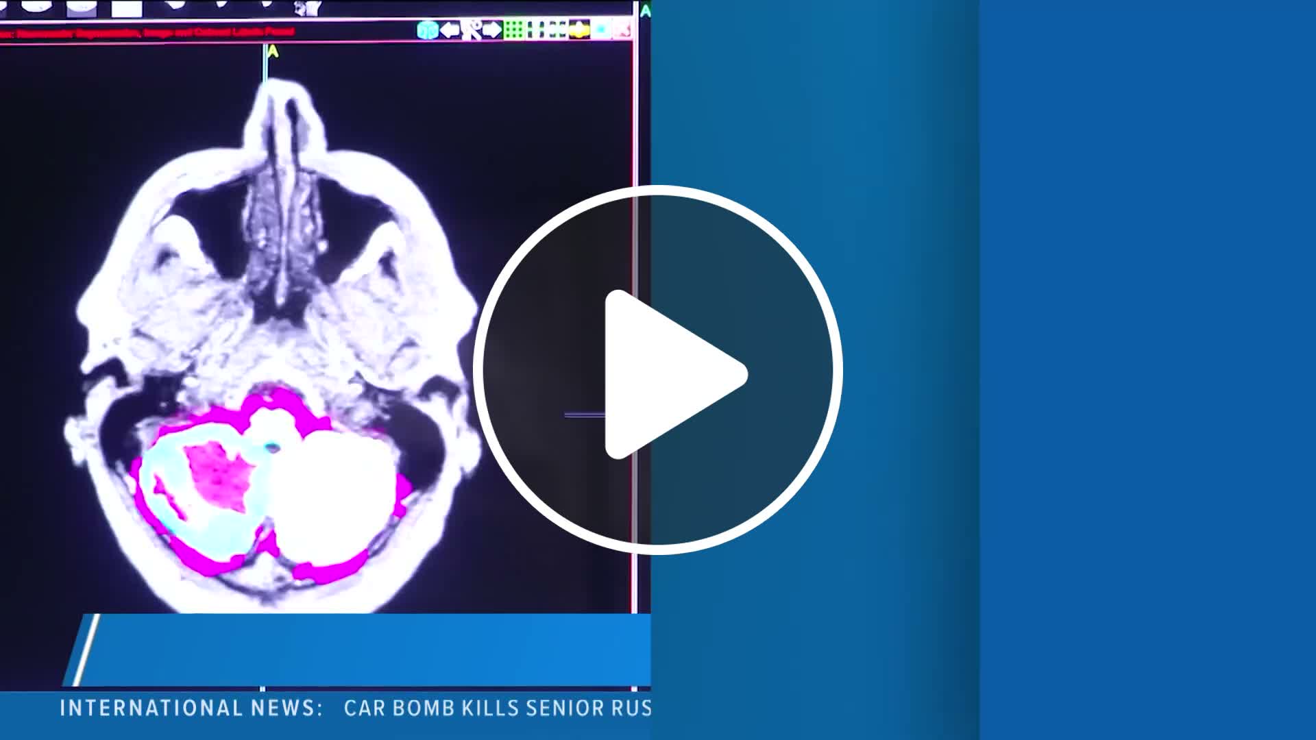 High-fat cheese, cream could lower dementia risk, study shows - NewsBreak