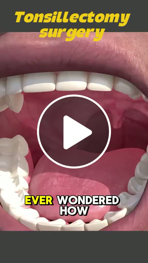 How Tonsillectomy Surgery Is Performed(3D Animation ...