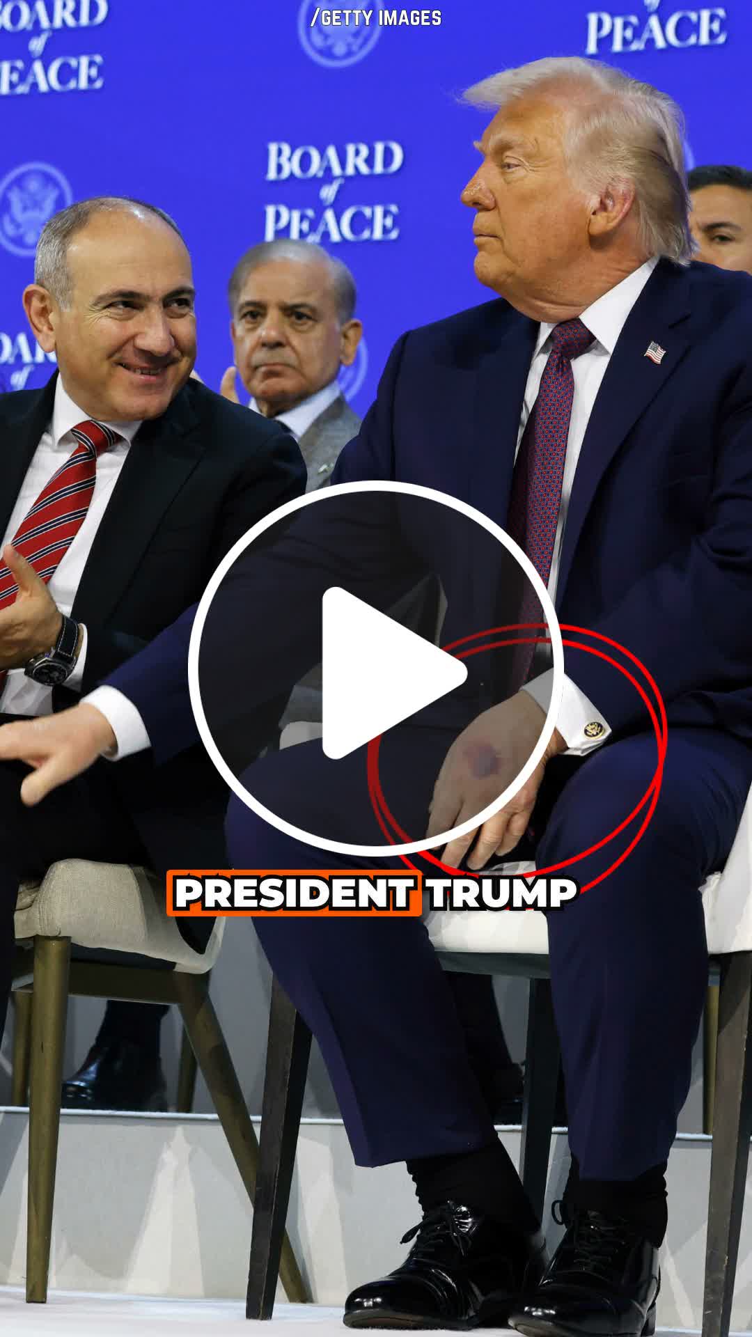 Trump explains fresh hand bruise after Davos event! - NewsBreak