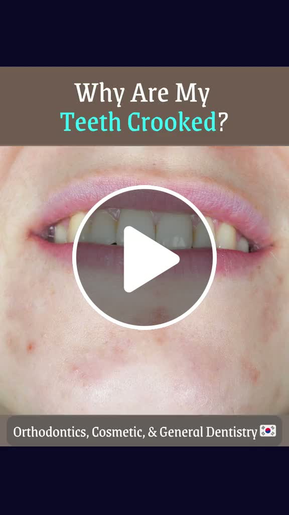 Why Are My Teeth Crooked? Wondering why teeth can become crooked? 😬 ...